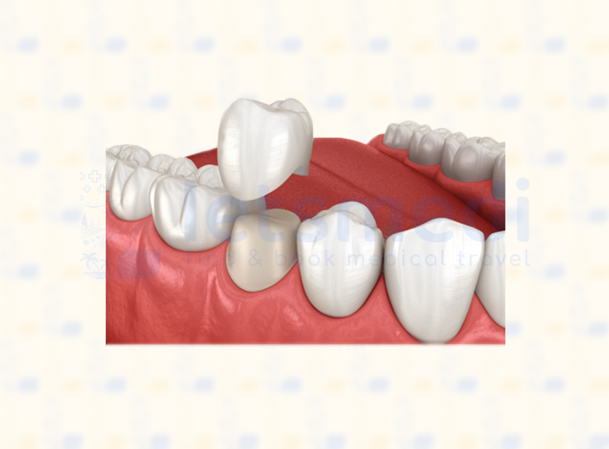 Emax Crowns in Turkey in 2024 - Letsmedi