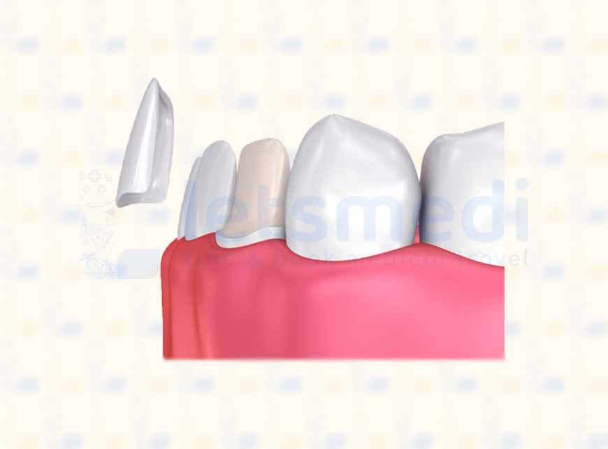 Zirconium Veneers in Turkey • Cost & Reviews in 2025 - Letsmedi