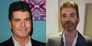 Simon Cowell Plastic Surgery - Before and After | Letsmedi